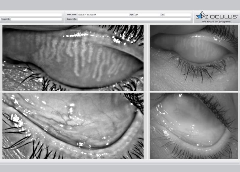 Dr. Edward Boshnick - Dry Eye Syndrome & Scleral Lenses