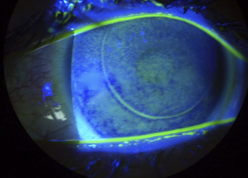 Dr. Edward Boshnick - Dry Eye Syndrome & Scleral Lenses