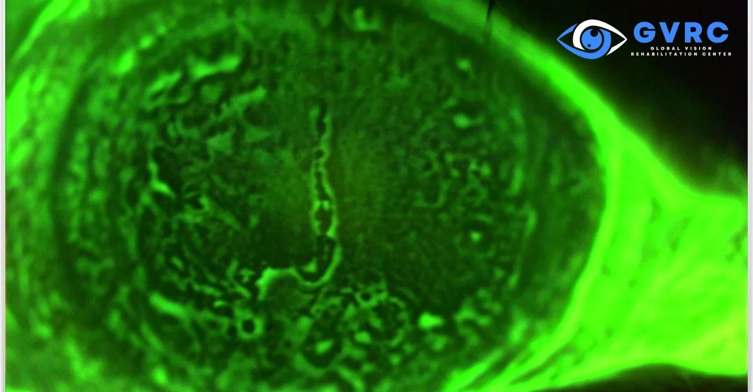 Scleral Lenses: The Ultimate Dry Eye Syndrome Solution