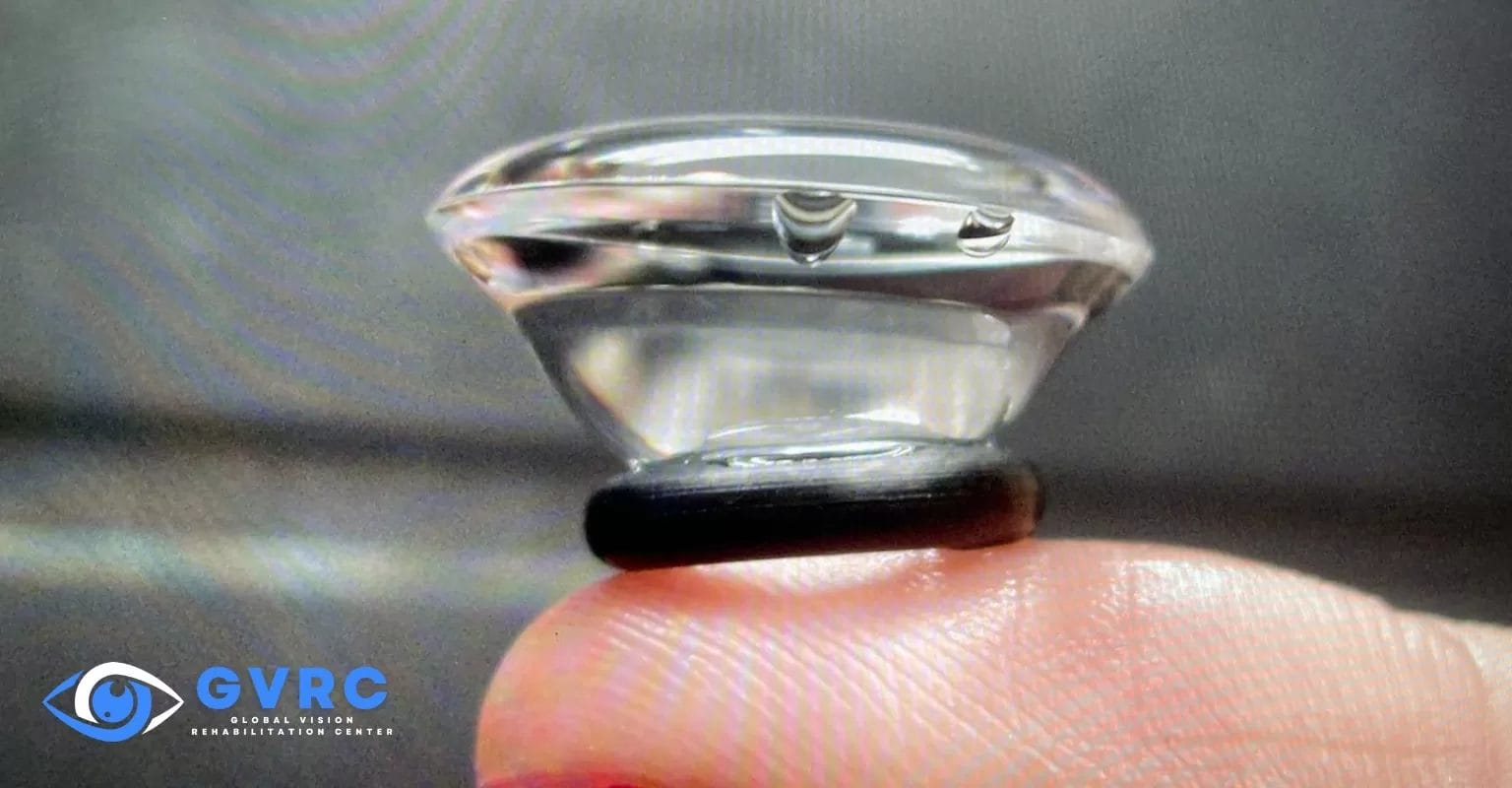 Scleral Lenses: The Ultimate Dry Eye Syndrome Solution