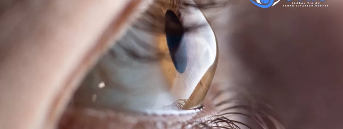 Scleral Lenses Transforming Vision For Keratoconus Patients