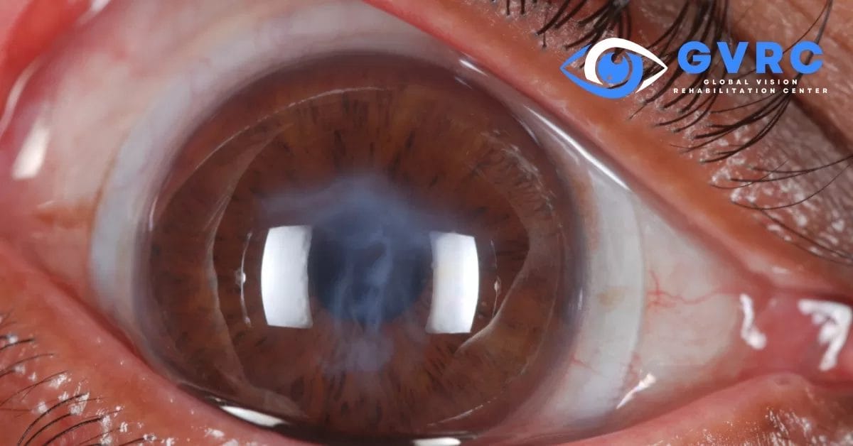 Best Keratoconus Treatment: Discover the Power of Scleral Lenses