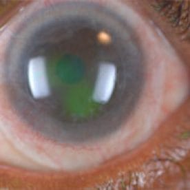 Dr. Edward Boshnick - Expert in Synergeyes Hybrid Lenses